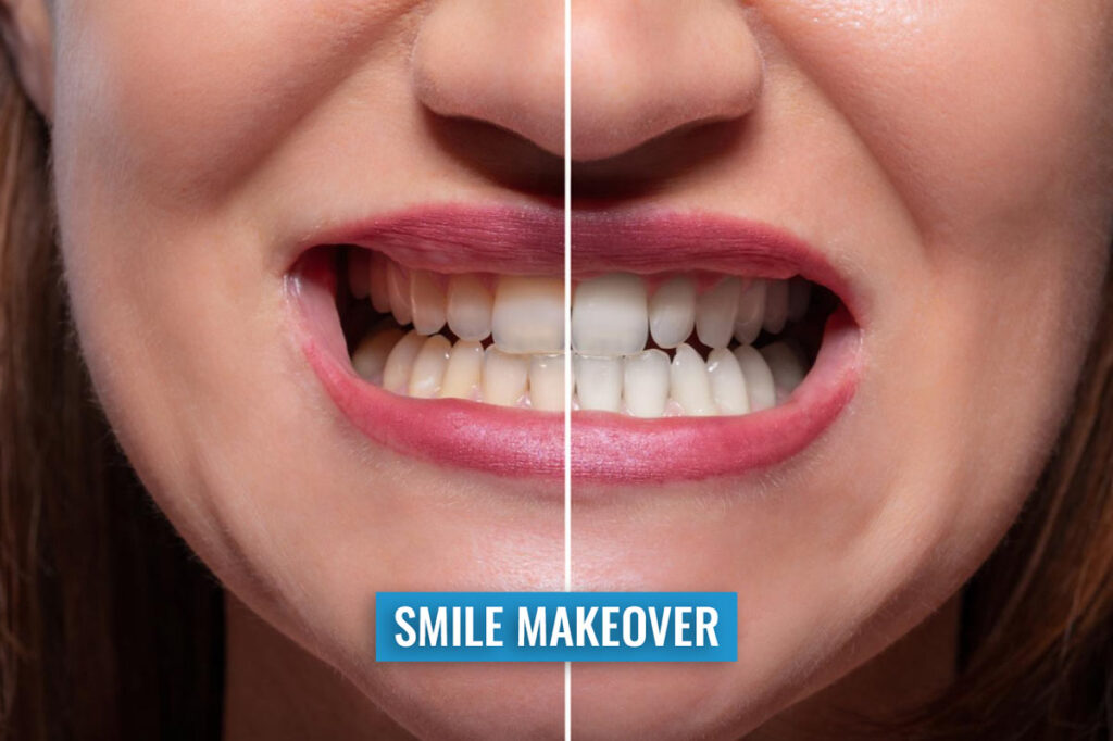 Smile Makeovers Explained: Combining Treatments for the Perfect Result